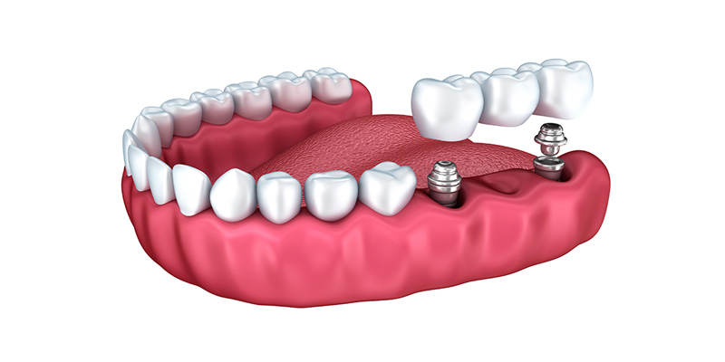 Implant Treatments